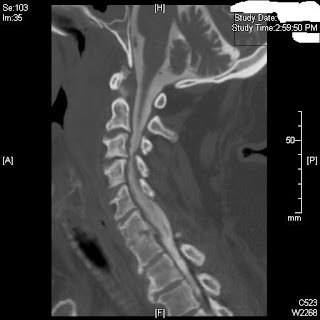 CT Pathology Blog: Cervical disc bulge